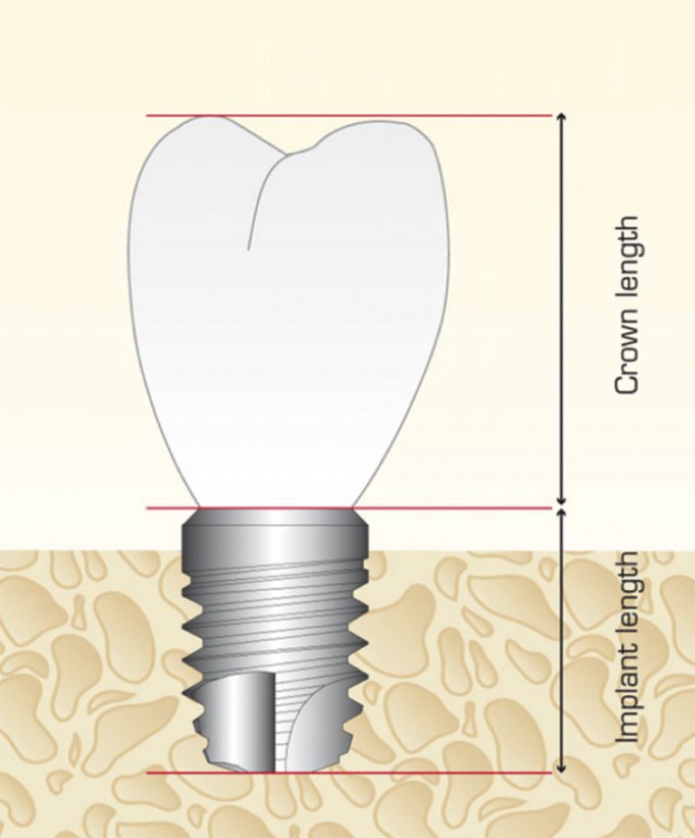 Crown-to-implant ratio - Scottish Dental magazine : Scottish Dental ...