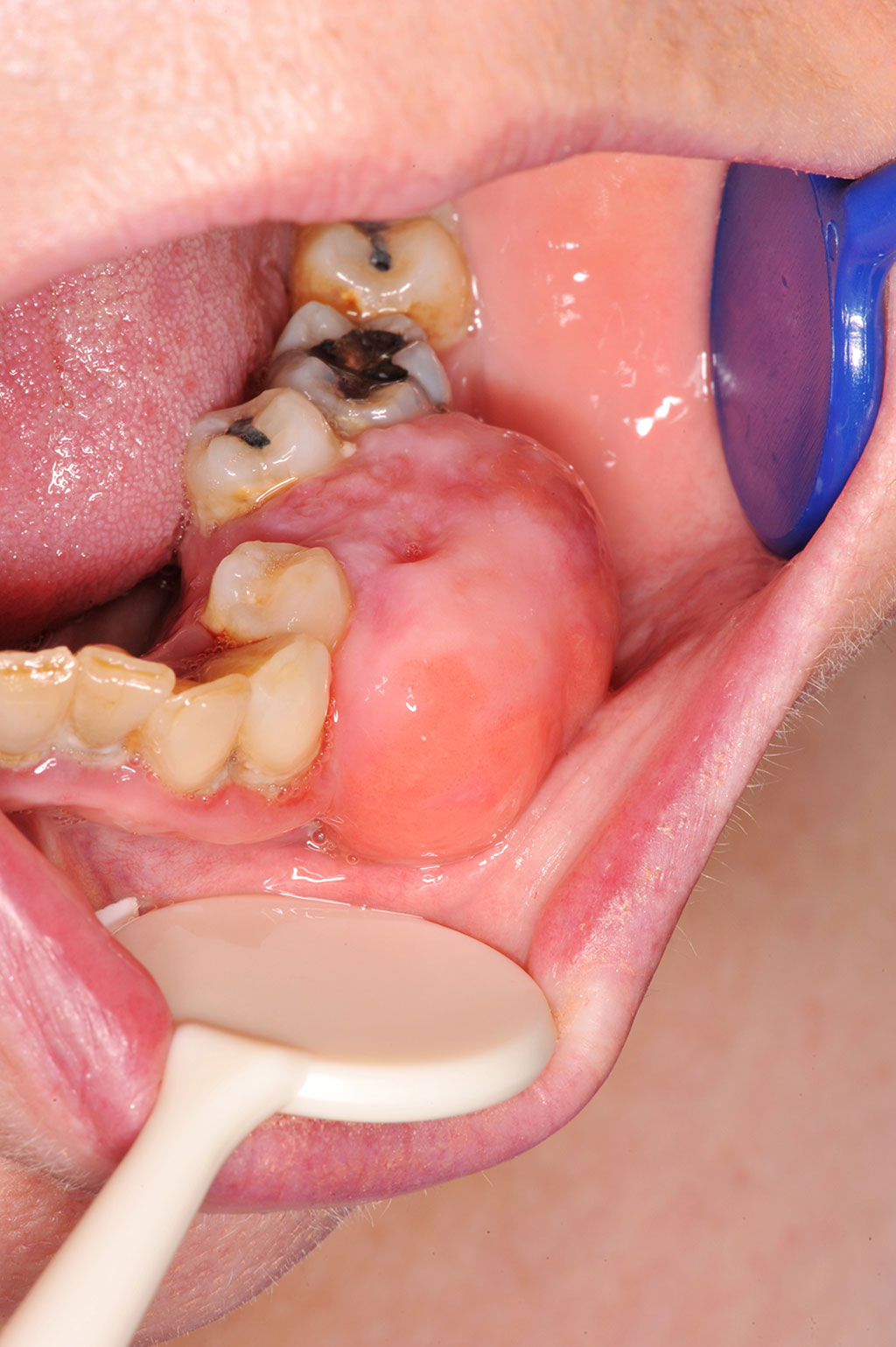 A Rapidly Growing Intraoral Lesion Scottish Dental Magazine