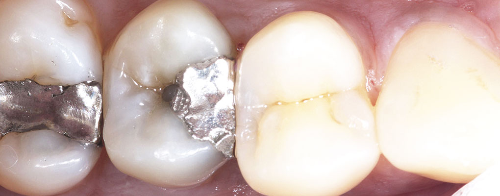 Quick, aesthetic restoration - Scottish Dental magazine : Scottish ...