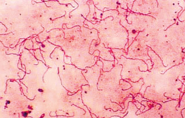 Oral syphilis – A case report - Scottish Dental magazine : Scottish ...