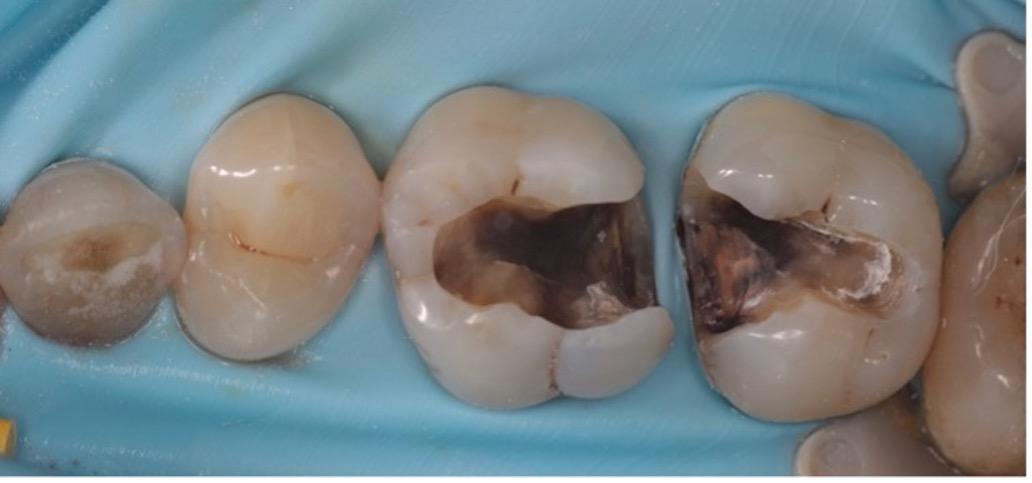 Ceramic onlays: indications and adhesive principles - Scottish Dental ...