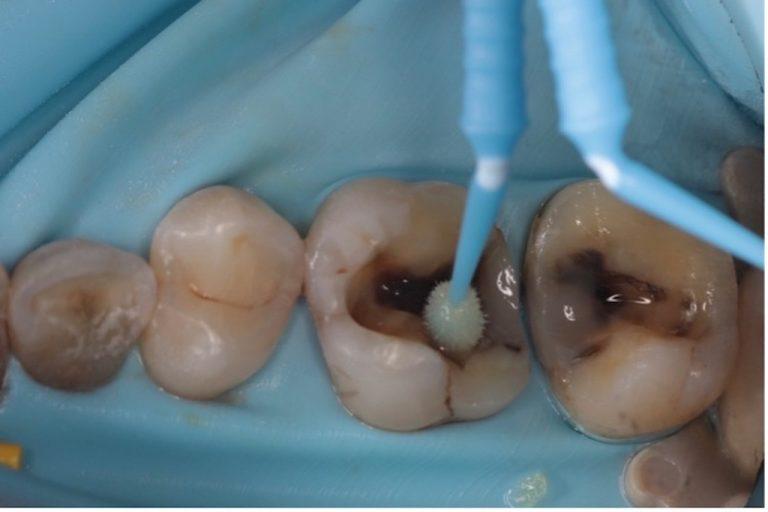 Ceramic onlays: indications and adhesive principles - Scottish Dental ...