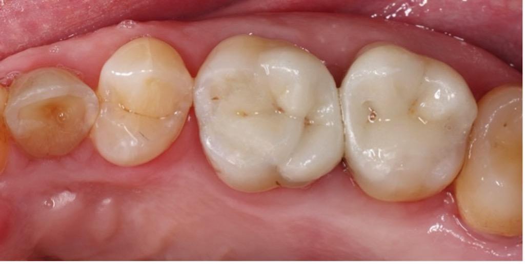 Ceramic onlays: indications and adhesive principles - Scottish Dental ...